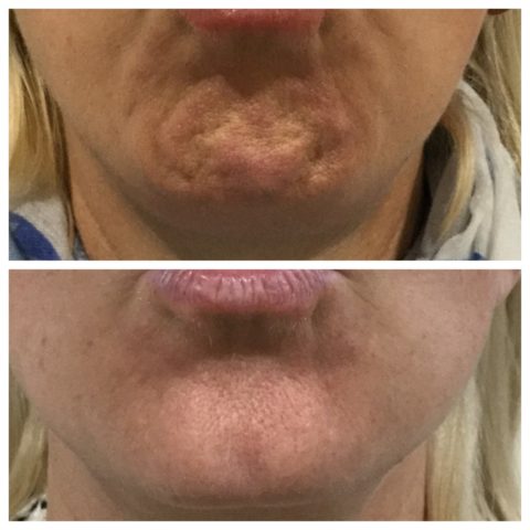 Wrinkle Relaxing Treatments (Botox®) - The Beauty Doctor Glasgow