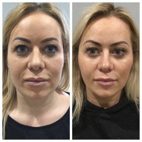 Wrinkle Relaxing Treatments (Botox®) - The Beauty Doctor Glasgow