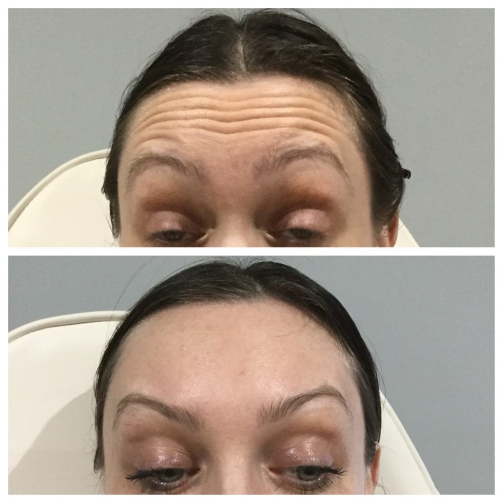 Wrinkle Relaxing Treatments (Botox®) - The Beauty Doctor Glasgow