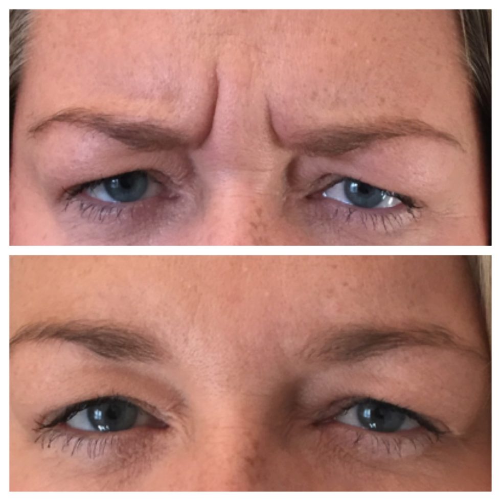 Wrinkle Relaxing Treatments (Botox®) - The Beauty Doctor Glasgow